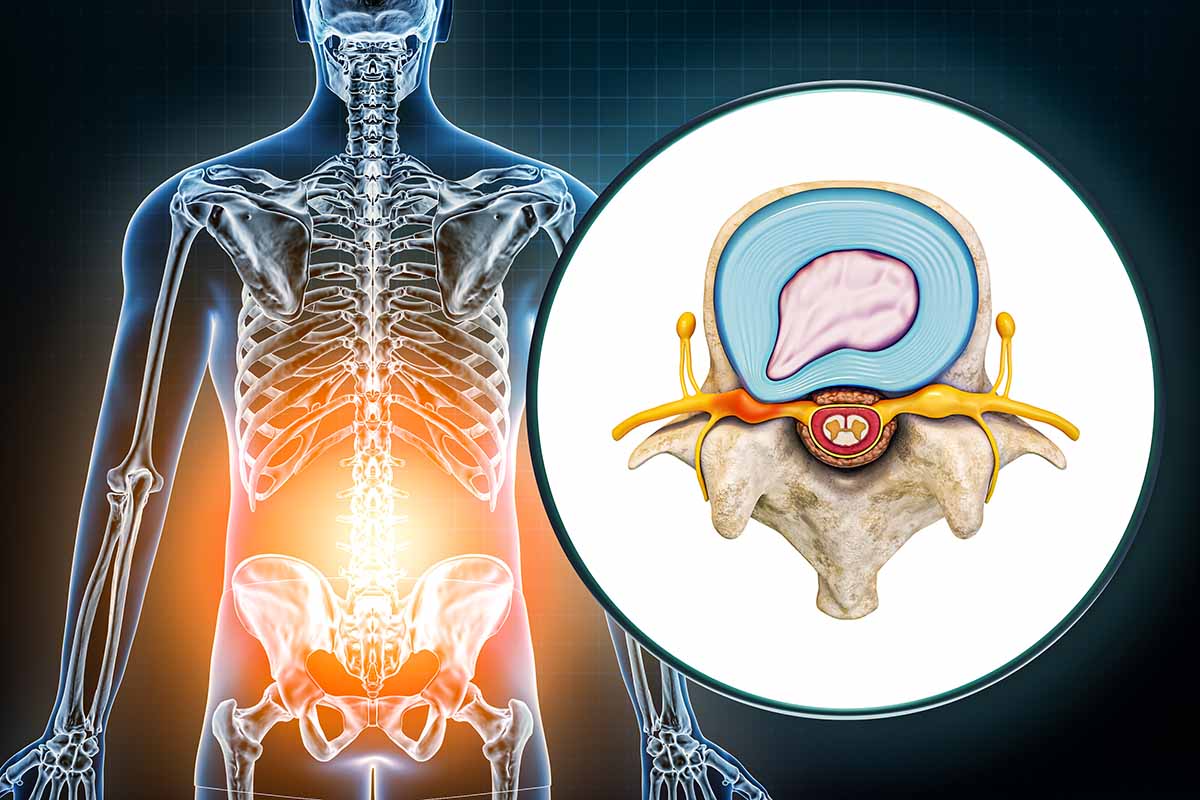 Micro-Discectomy for Herniated Discs